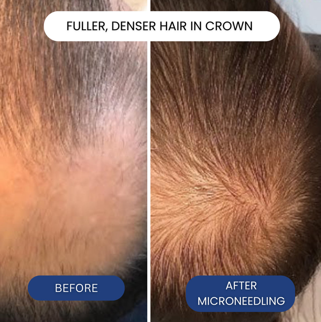 Micro-Infusion Copper Peptide, Licorice Root, Ginseng - System For Hair ...